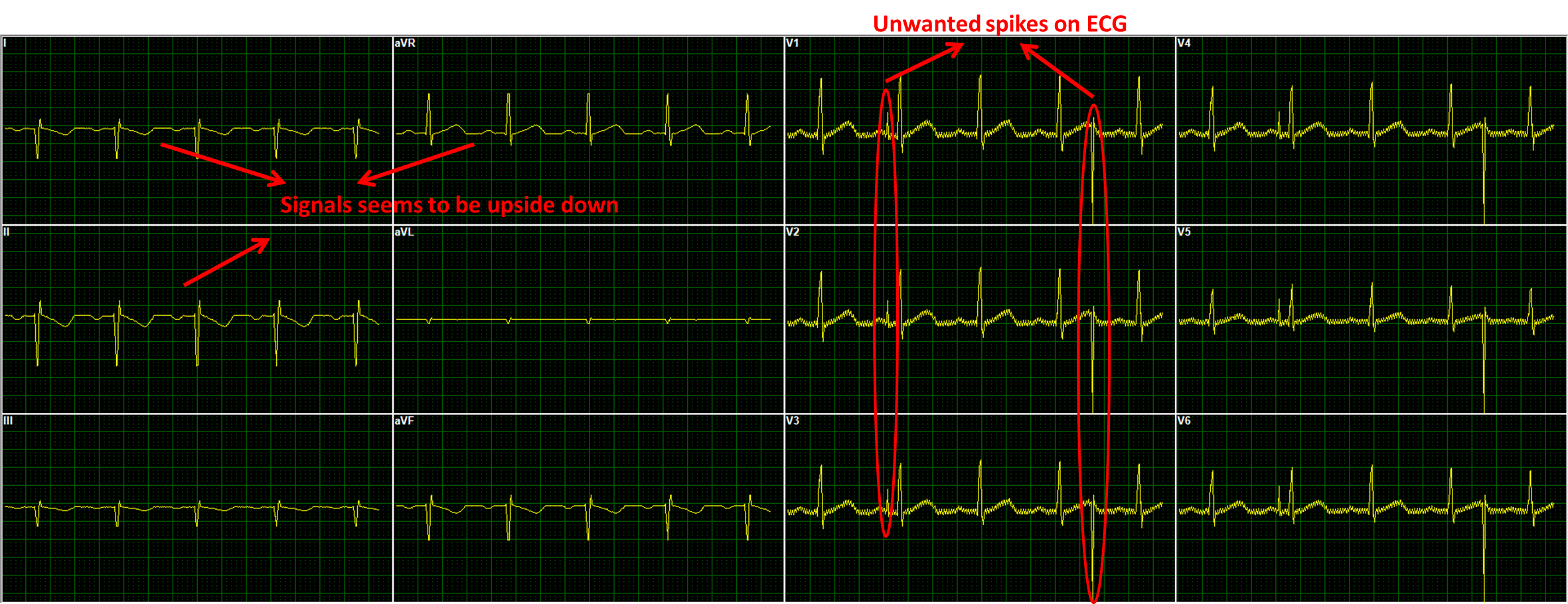 ADS1298 Signal Properties - Data converters forum - Data converters ...
