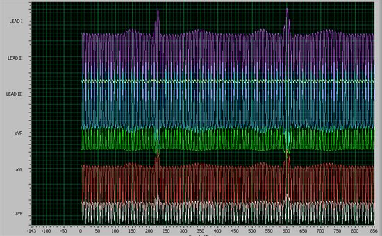 Question about ADS1298 ECG evaluation board simulator - Data converters ...